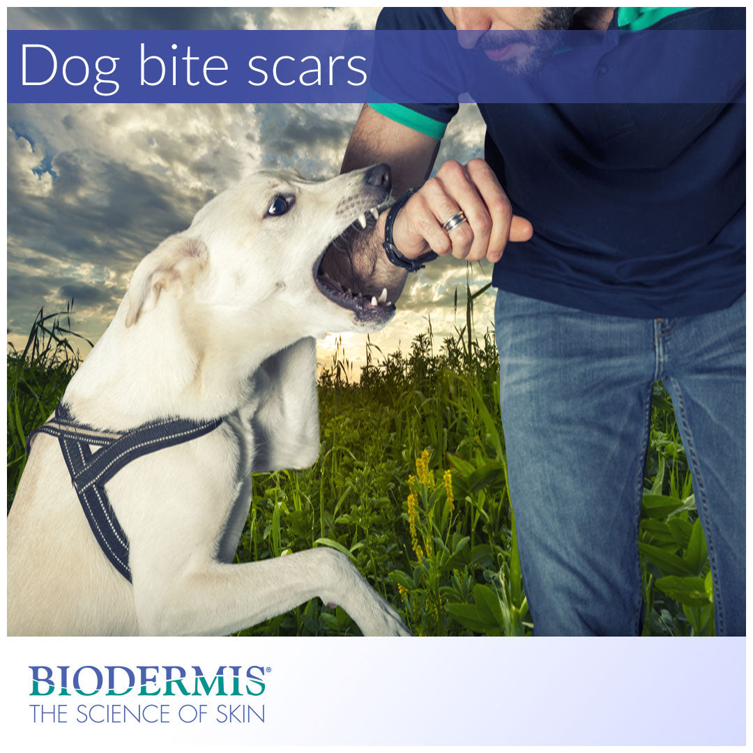 How to Effectively Treat Dog Bite Scars | Biodermis.com