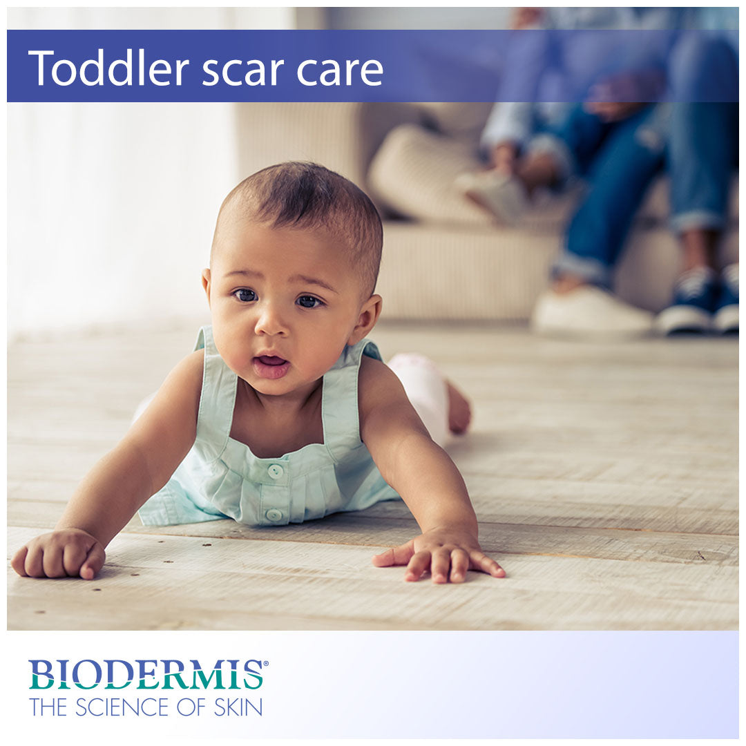 How to Treat and Prevent Scars in Toddlers and Babies | Biodermis.com