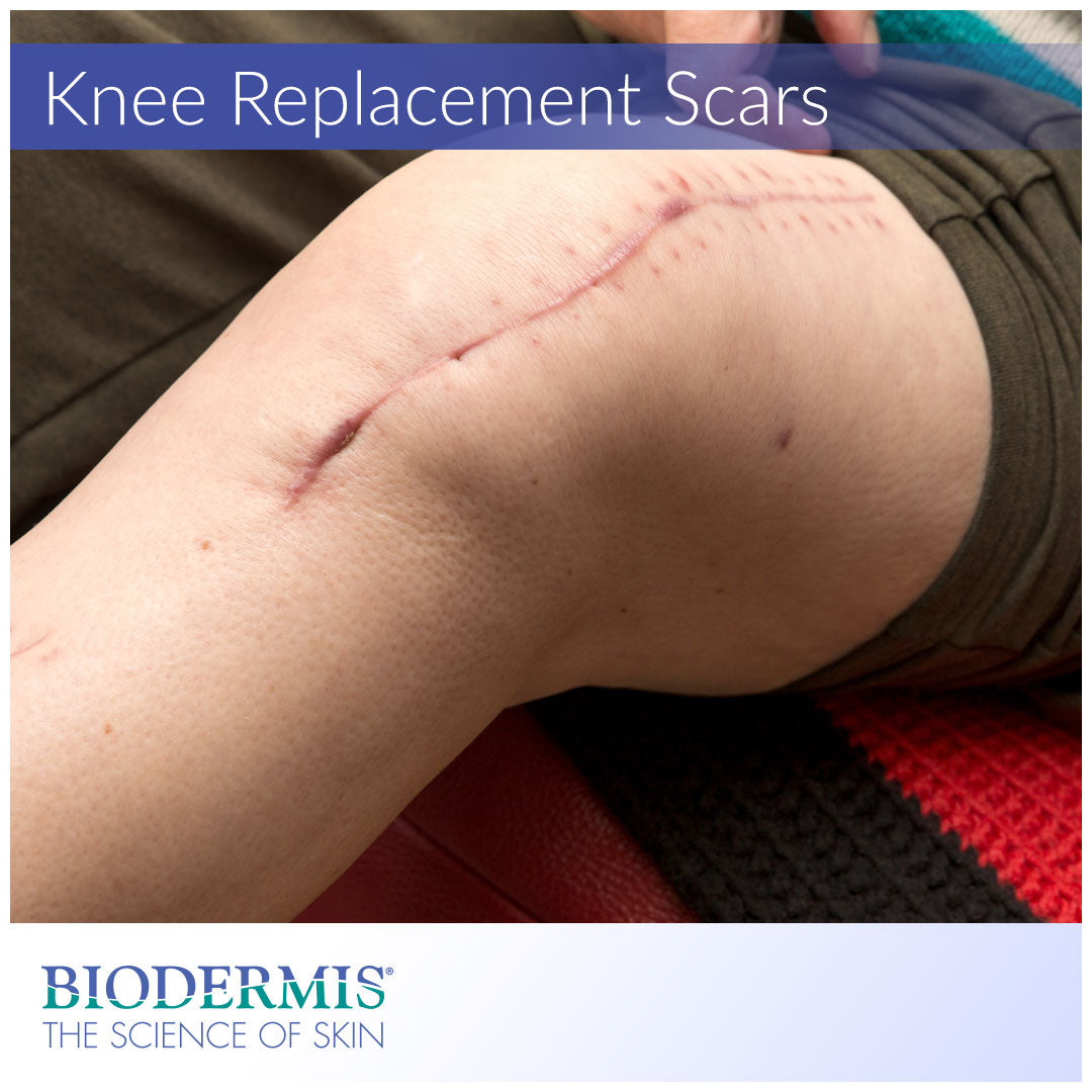 Knee Replacement Surgery and Scar Management | Biodermis.com