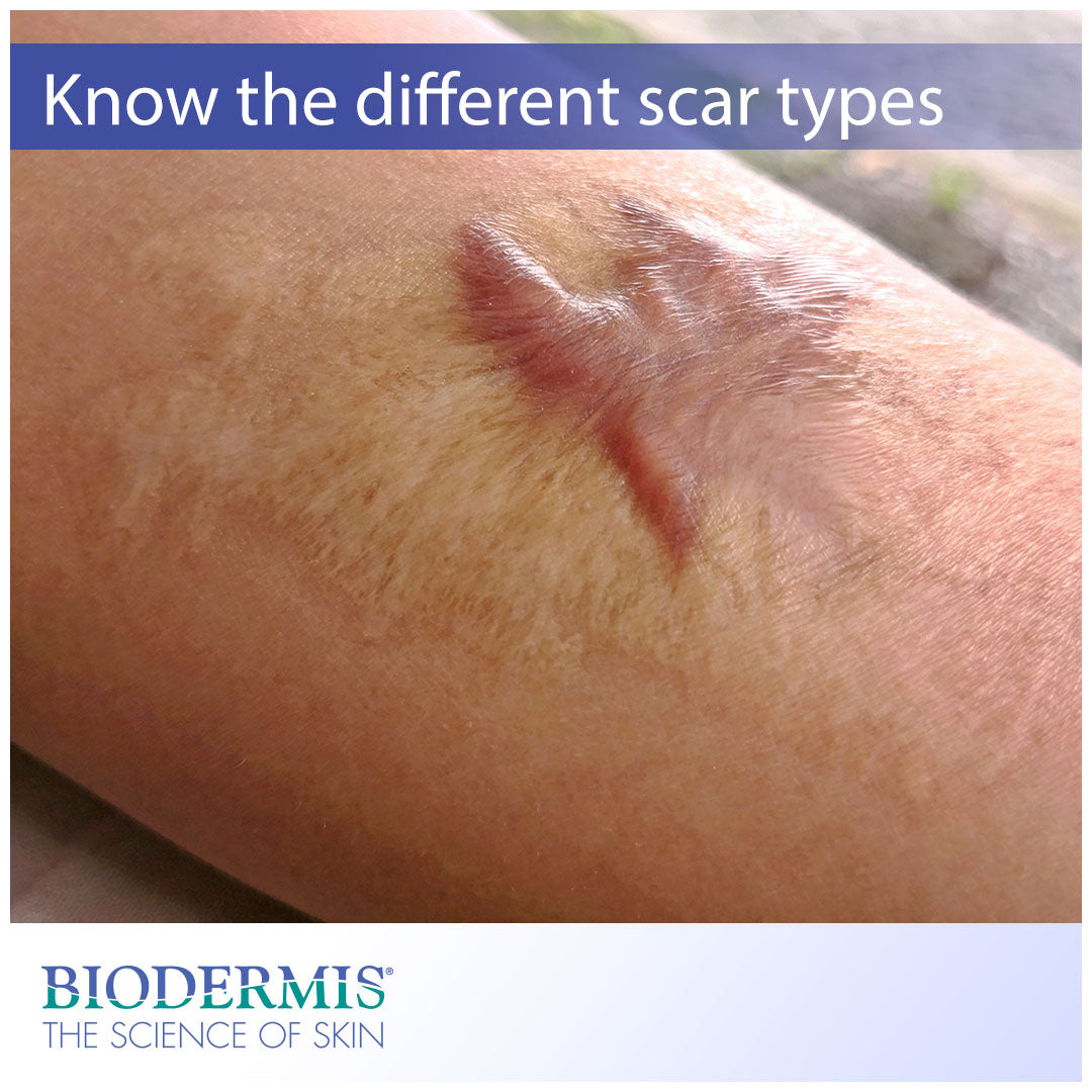 Know the Different Types of Scars and How to Treat Them | Biodermis.co