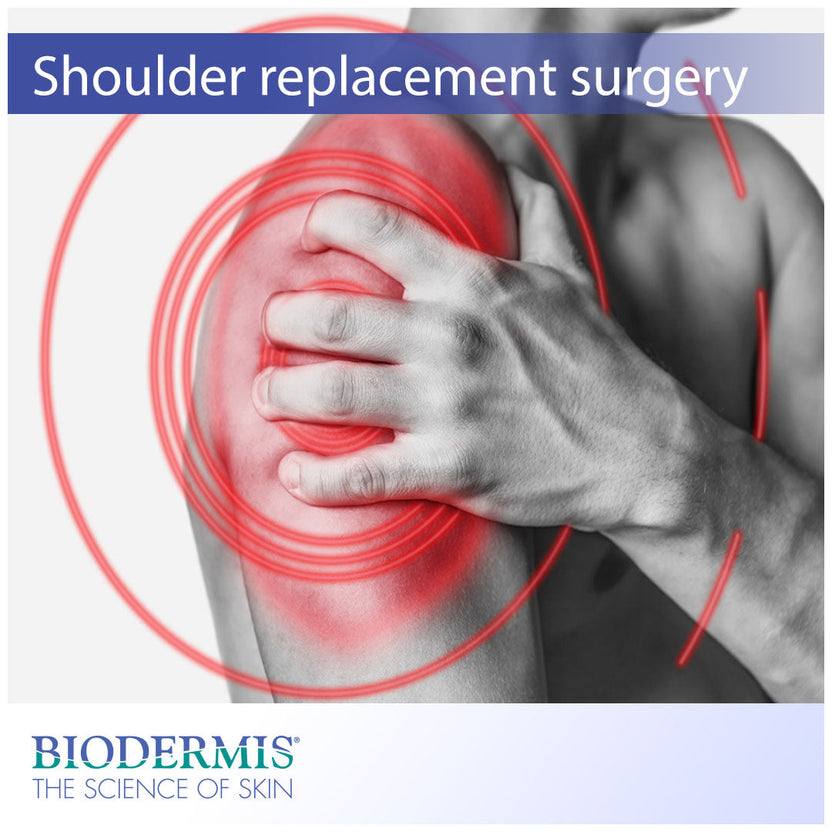Shoulder Replacement Surgery and Scar Management | Biodermis.com