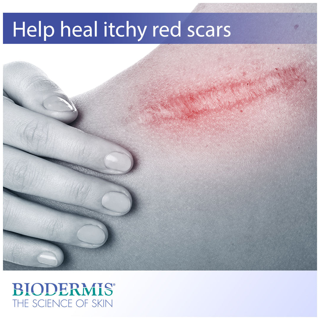 What to do About Itchy Red Scars | Biodermis.com
