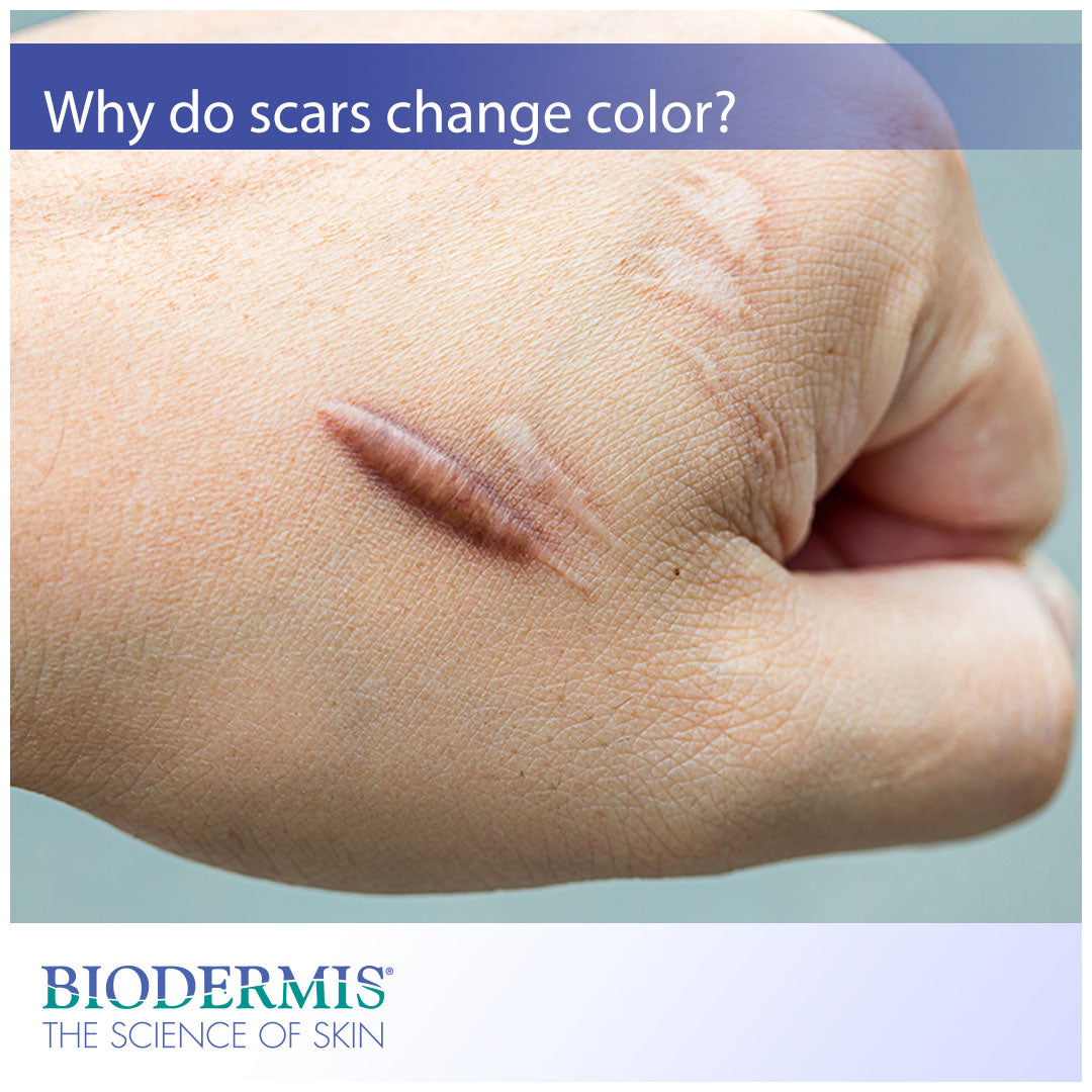 Why Do Scars Change Color? | Biodermis.com