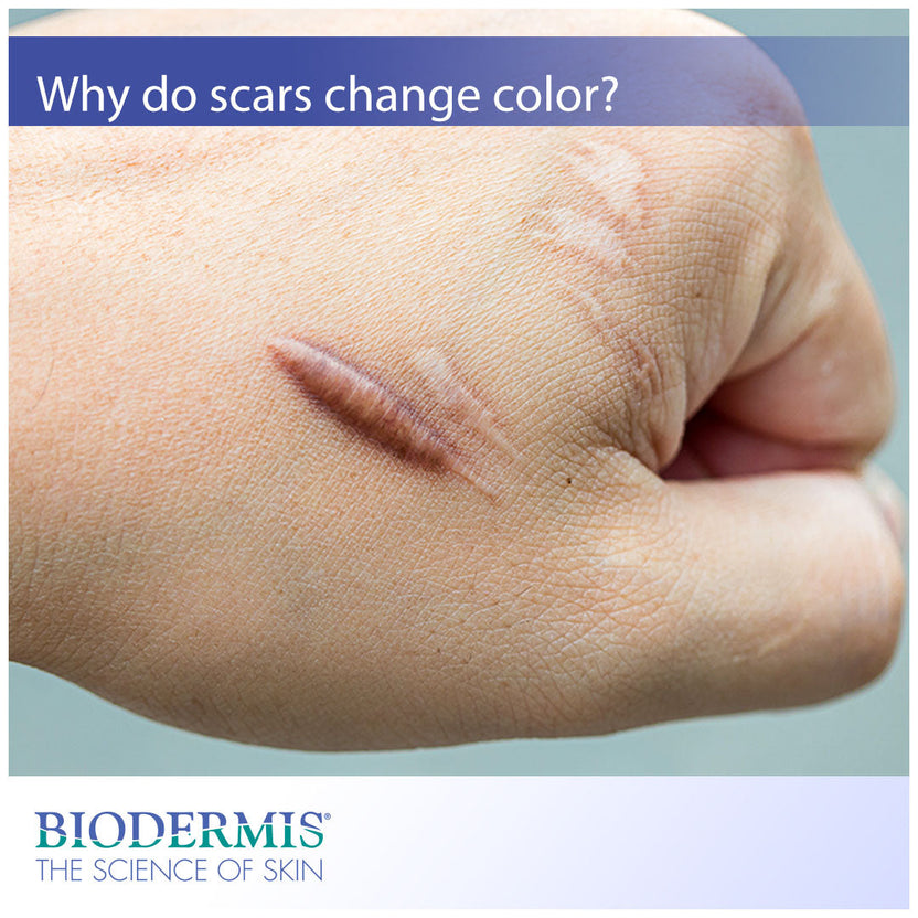 Why Do Scars Change Color? | Biodermis.com