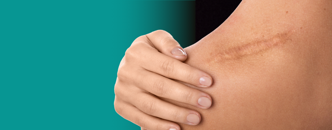 How to Reduce Surgery Scars Naturally: Effective Remedies and Tips ...