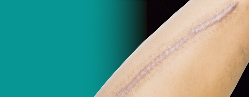 What Are the 3 Types of Scars? – Biodermis