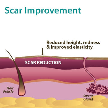 Breast Reduction Scars - 1 Pair Epi-Derm Mastopexy | BIODERMIS – Biodermis